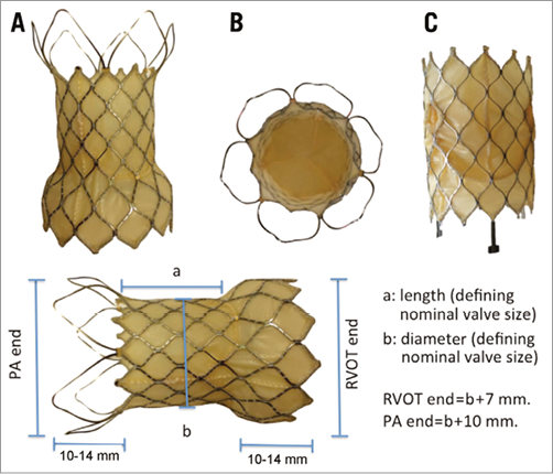 Early European experience with the Venus P-valve®: filling the gap in ...