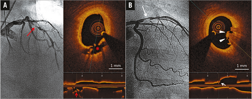 Culprit plaque morphology in STEMI – an optical coherence tomography ...