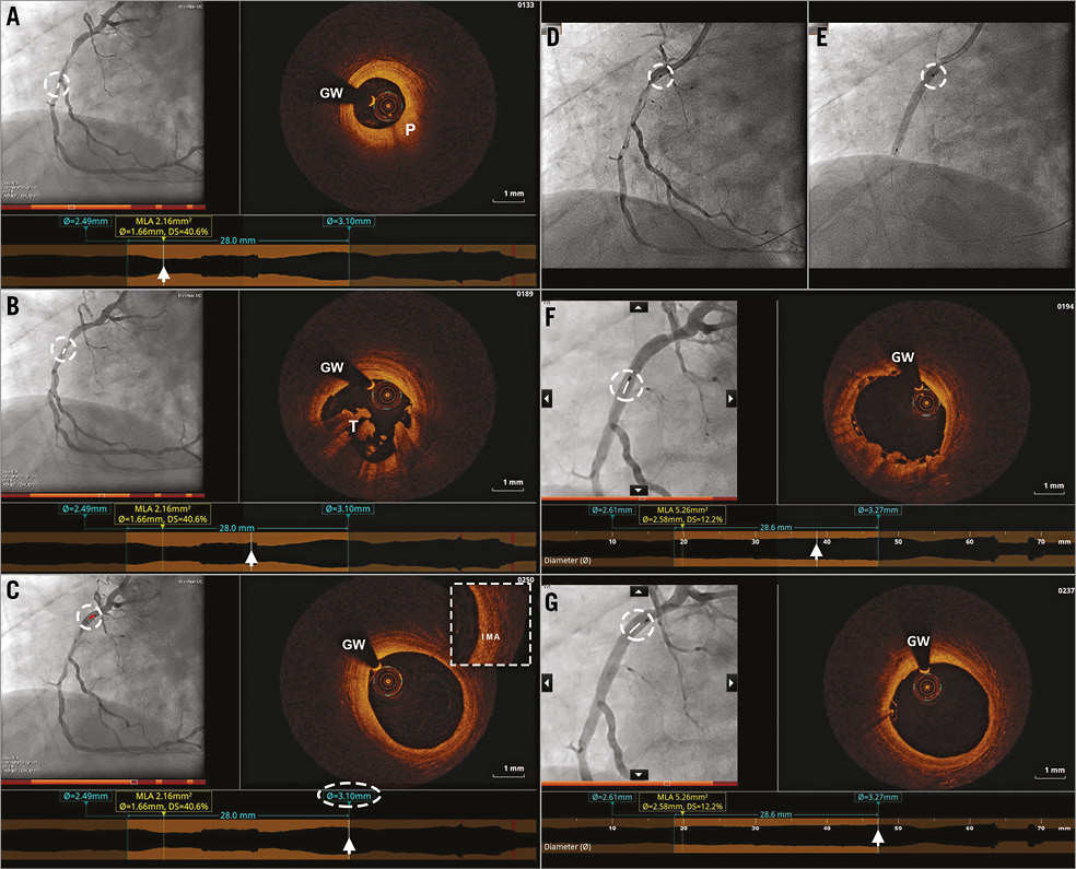 The OPTIS Integrated System: real-time, co-registration of angiography ...