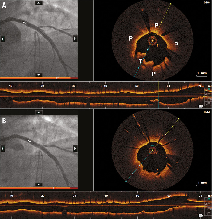 The OPTIS Integrated System: real-time, co-registration of angiography ...