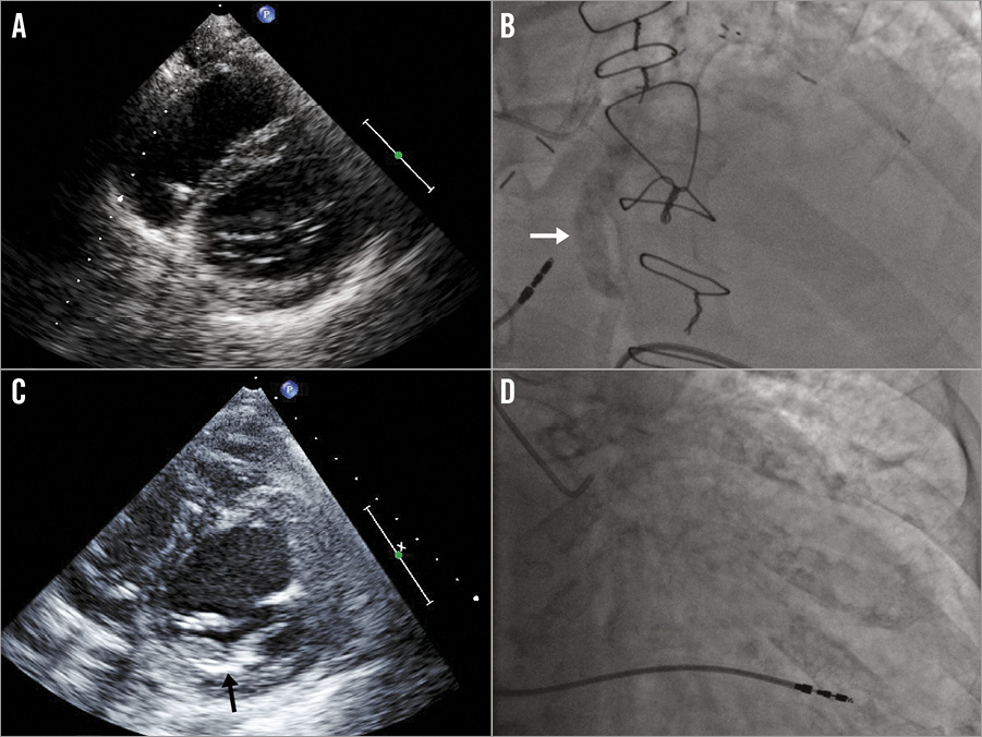 Mitral annular calcification is not associated with decreased ...