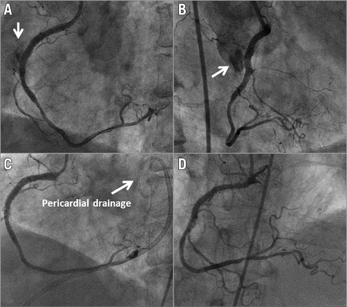 Coronary covered stents - EuroIntervention