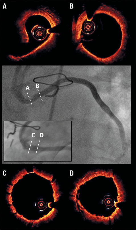 Coronary covered stents - EuroIntervention