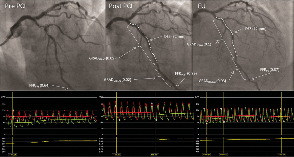 FFR result post PCI is suboptimal in long diffuse coronary artery ...