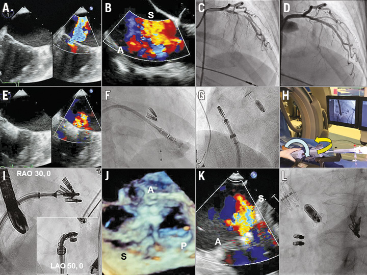 First percutaneous Micra leadless pacemaker implantation and tricuspid ...