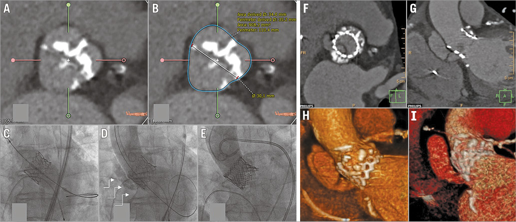 Annulus rupture post transcatheter aortic valve implantation ...