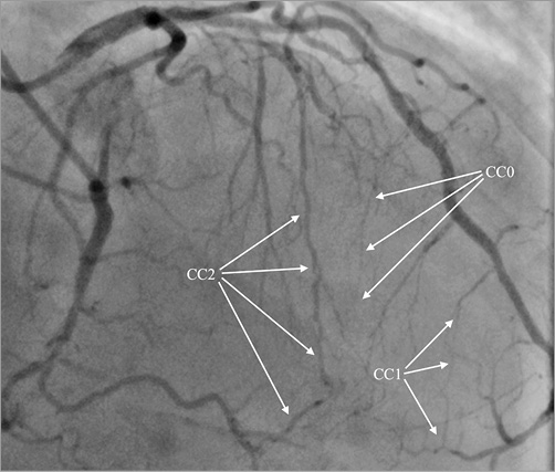 Safety and effectiveness of the surfing technique to cross septal ...
