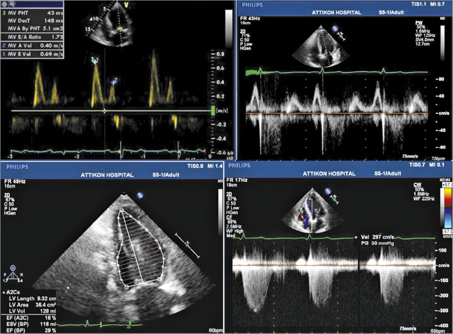 How should I treat a TAVI-eligible patient with a left ventricular ...