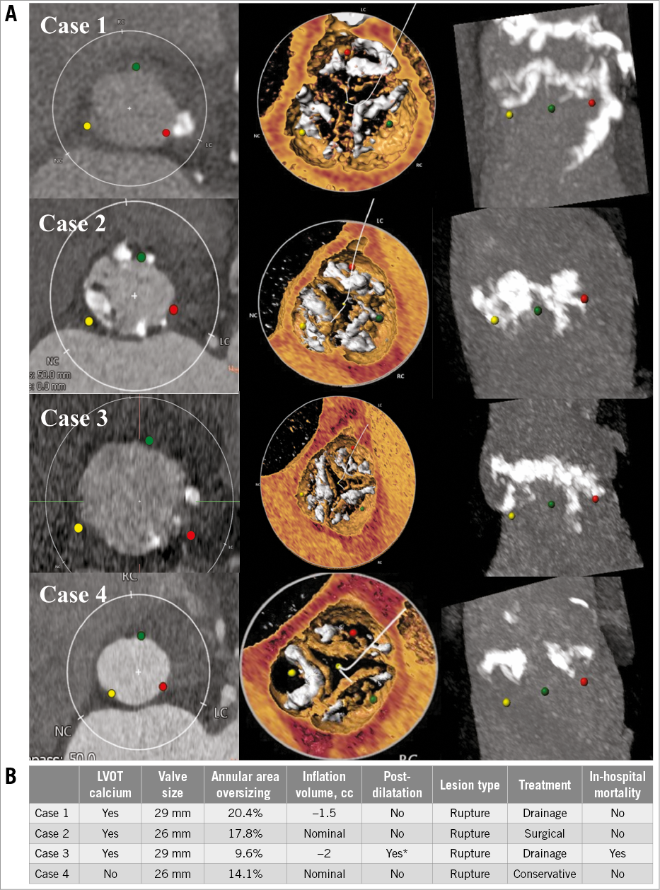 Optimal sizing for SAPIEN 3 transcatheter aortic valve replacement in ...