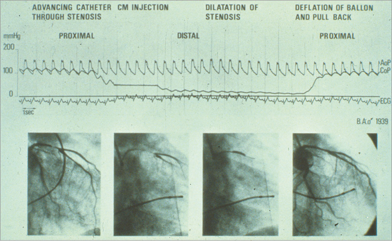 His master’s art, Andreas Grüntzig’s approach to performing and ...