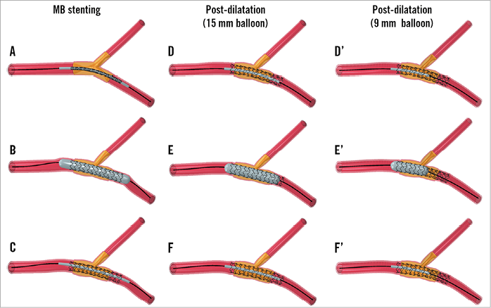 Impact of plaque type and side branch geometry on side branch ...