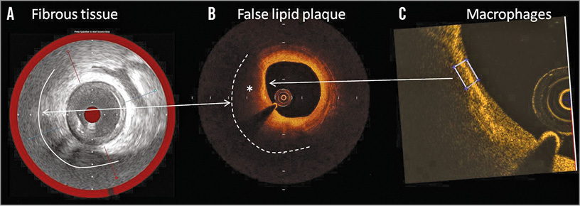 Limitations of OCT in identifying and quantifying lipid components: an ...