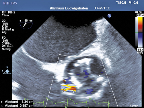 How should I treat recurrent severe paravalvular leakage after ...