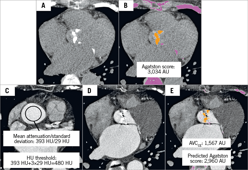 Quantification of aortic valve calcification on contrast-enhanced CT of ...