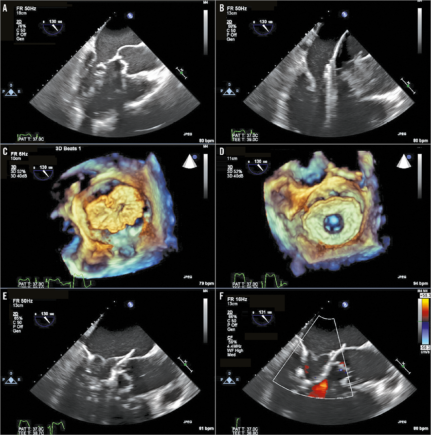 Transcatheter mitral valve replacement: long-term outcomes of first-in ...