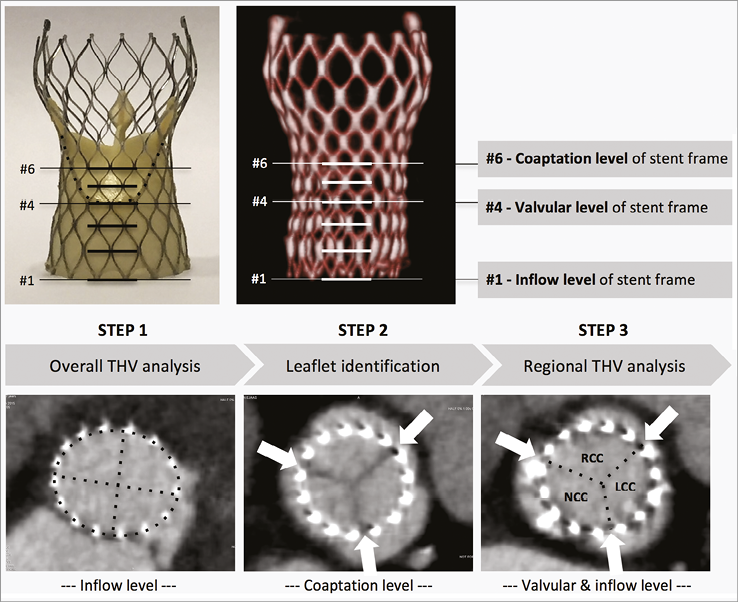 Subclinical leaflet thickening and stent frame geometry in self ...