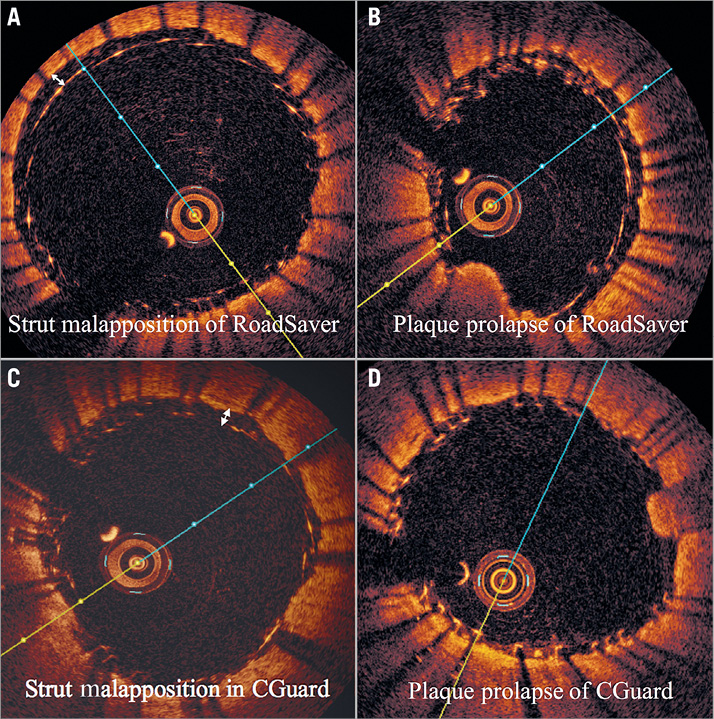 Optical coherence tomography assessment of new-generation mesh-covered ...