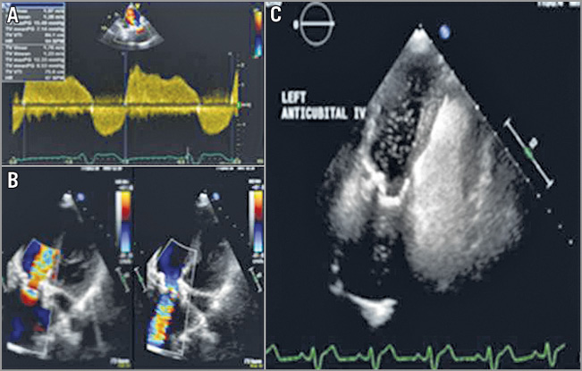 How should I treat a left persistent superior vena cava with unroofed ...