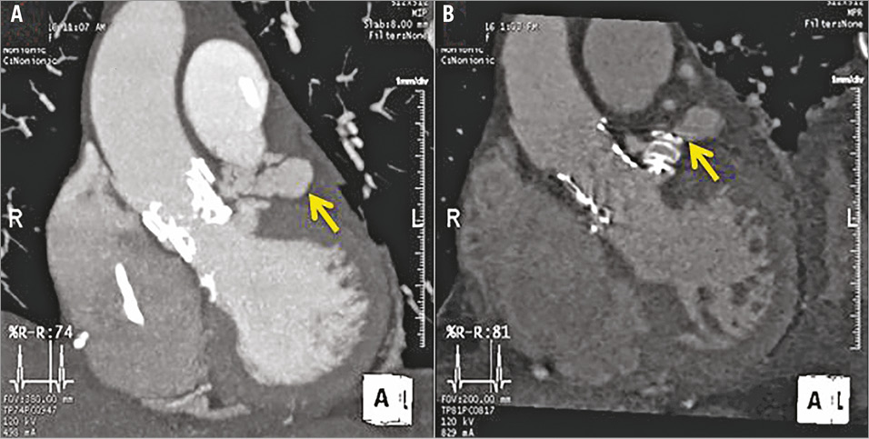 Percutaneous closure of subannular rupture following transcatheter ...