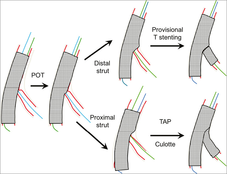 Percutaneous coronary intervention for the left main stem and other ...