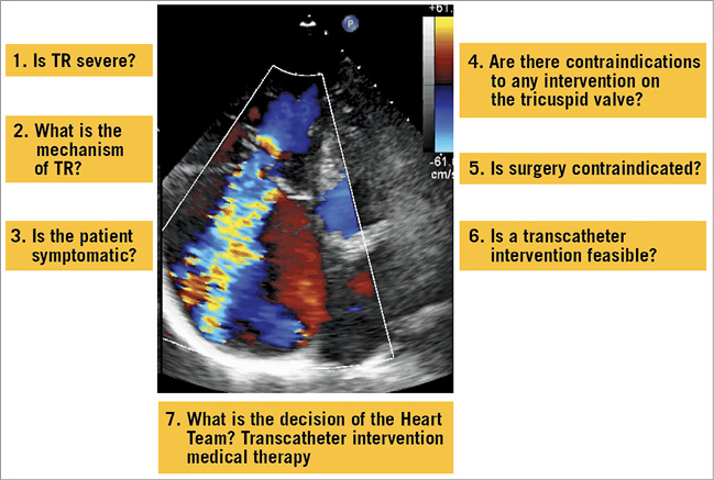 Transcatheter tricuspid intervention: the new challenge of structural ...
