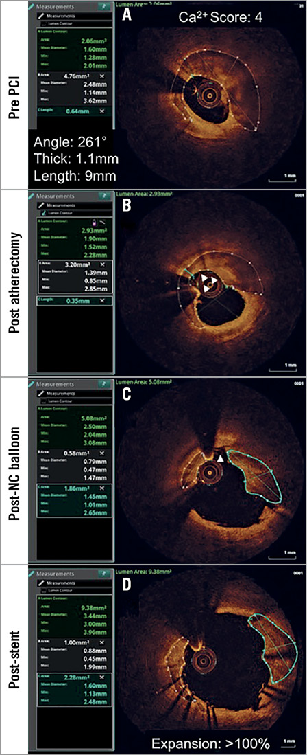 Shining light on calcified lesions, plaque stabilisation and ...
