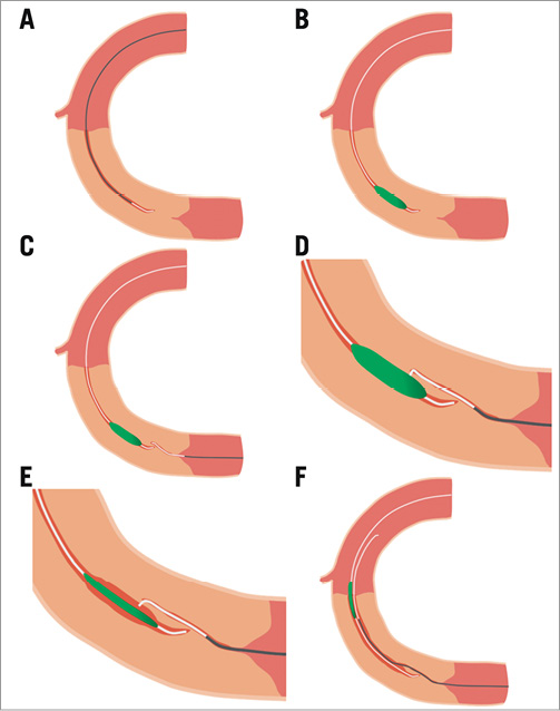 Overview and proposed terminology for the reverse controlled antegrade ...