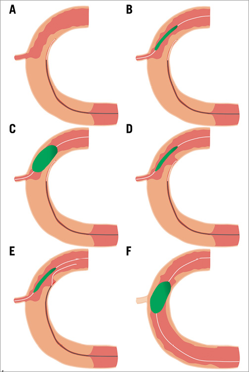 Overview and proposed terminology for the reverse controlled antegrade ...