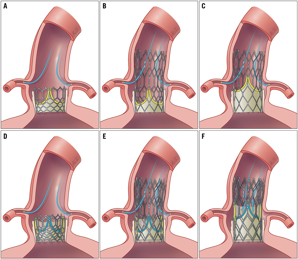 Transcatheter aortic valve implantation: don’t forget the coronary ...