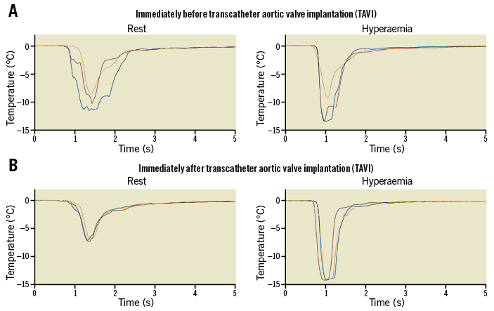 Left ventricular afterload reduction by transcatheter aortic valve ...