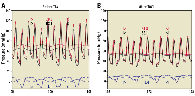 Left ventricular afterload reduction by transcatheter aortic valve ...