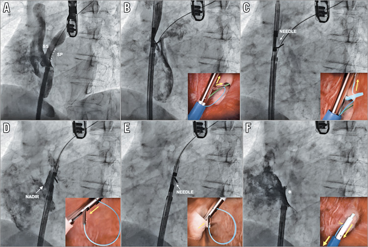 Novel percutaneous suture-mediated patent foramen ovale closure ...