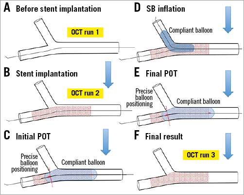 Benefit of a new provisional stenting strategy, the re-proximal optimisation technique: the ...