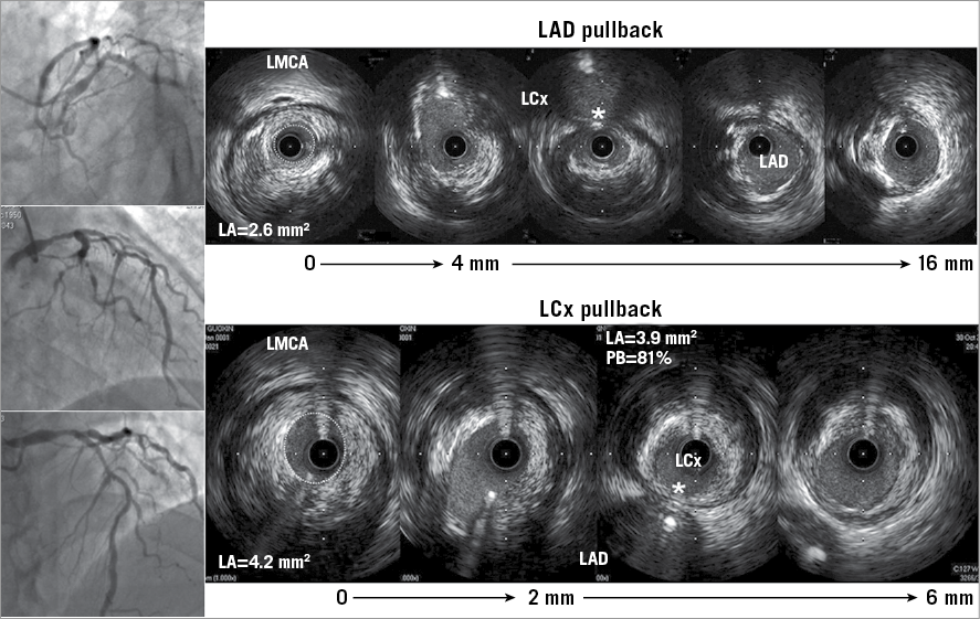 Intravascular ultrasound in the evaluation and treatment of left main ...