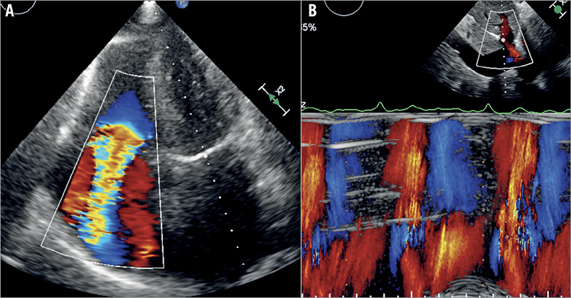 First-in-man implantation of the Tricento transcatheter heart valve for ...
