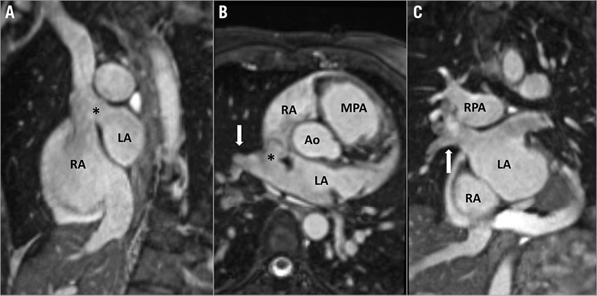 Early experience of transcatheter correction of superior sinus venosus ...