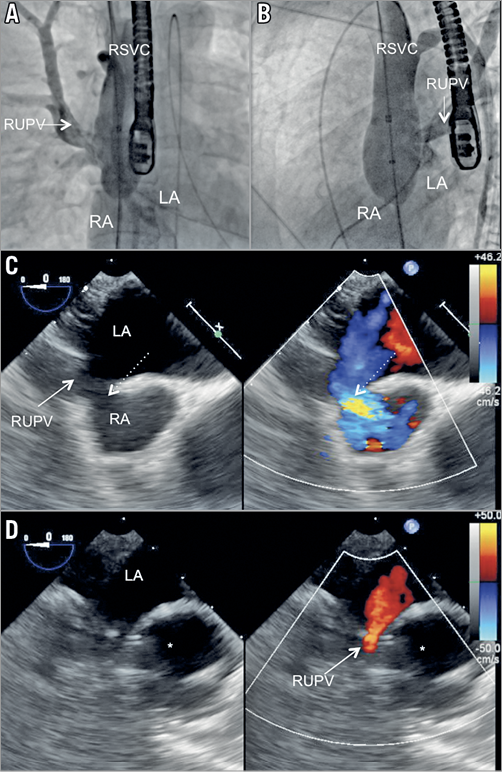 Early experience of transcatheter correction of superior sinus venosus ...