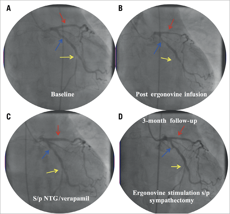 Coronary vasospastic angina: a rare case of ergonovine positivity and ...