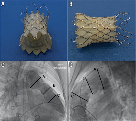 Medium-term results of percutaneous pulmonary valve implantation using ...