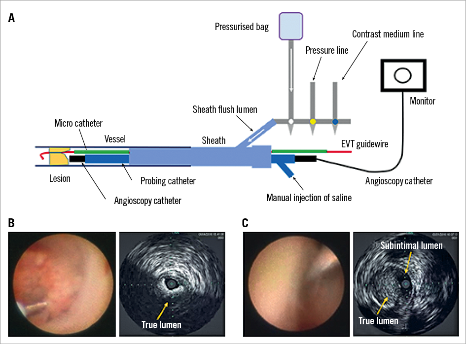 Initial result of an angioscopy-guided wire crossing technique under ...