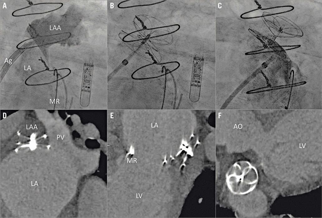 Management of incomplete surgical left atrial appendage exclusion ...