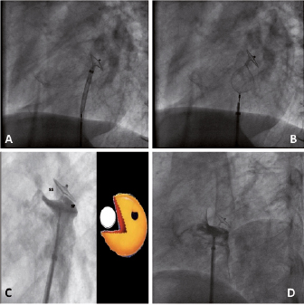 Tools & Techniques: PFO/ASD closure - EuroIntervention