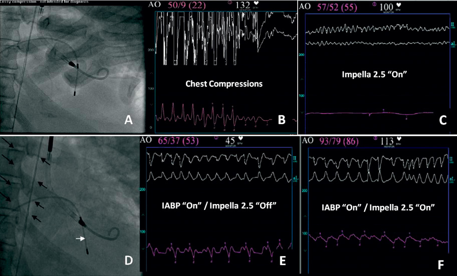 Use of the Impella 2.5 system alone, after and in combination with an ...