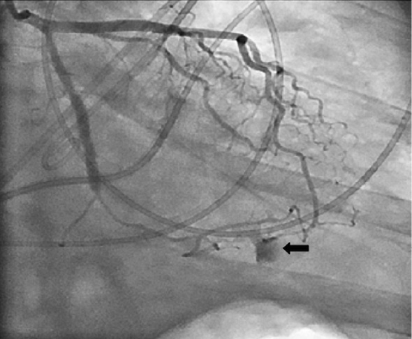 How should I treat guidewire-induced distal coronary perforation ...
