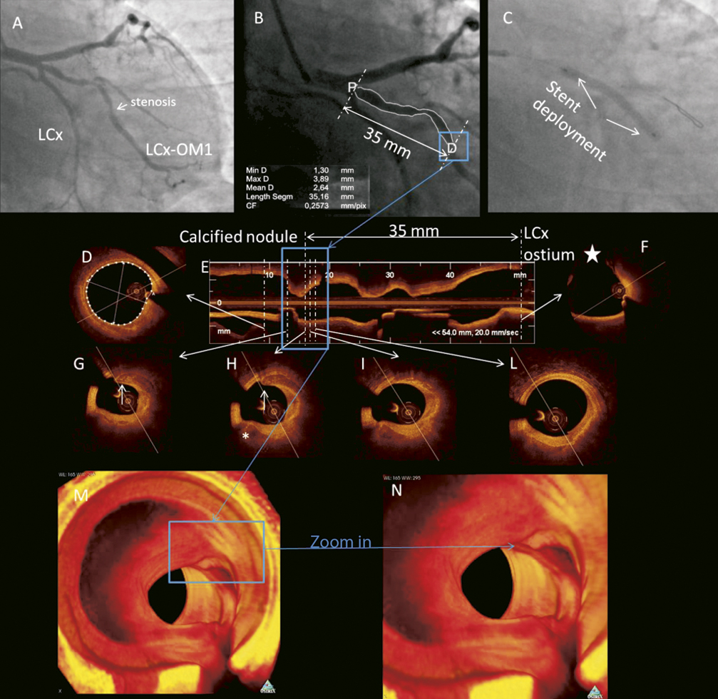 Coronary artery perforation imaged through 3-dimensional optical ...
