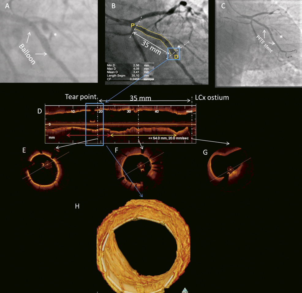 Coronary artery perforation imaged through 3-dimensional optical ...