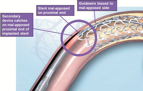 Longitudinal stent deformation: a retrospective analysis of frequency ...