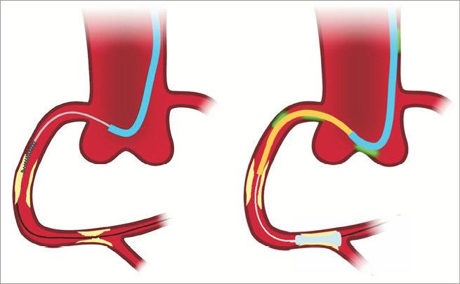 Guide catheter extensions: where are they taking us? - EuroIntervention