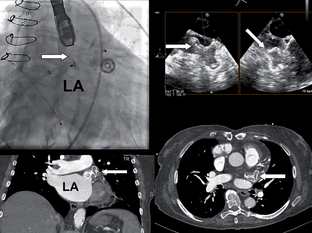 Percutaneous mechanical thrombectomy of left atrial appendage thrombus ...