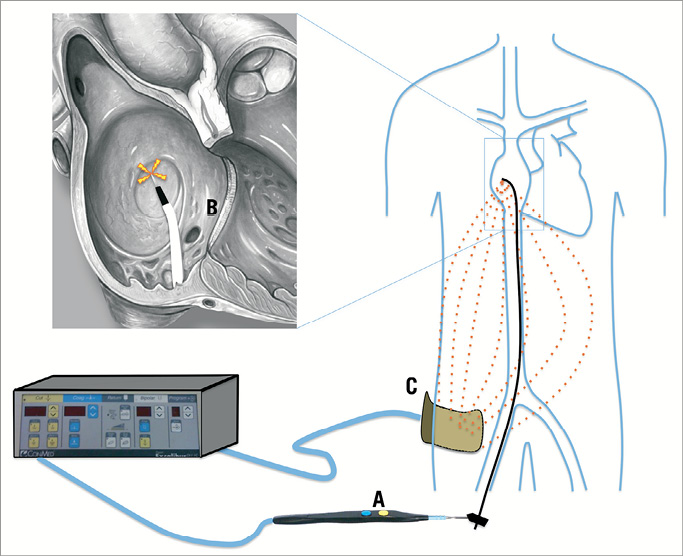 Transseptal access for MitraClip® procedures using surgical diathermy ...